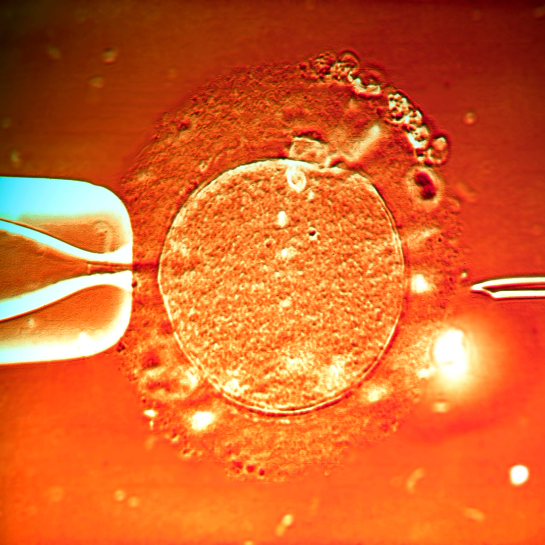 Intracytoplasmic sperm injection (ICSI) - TIARA IVF